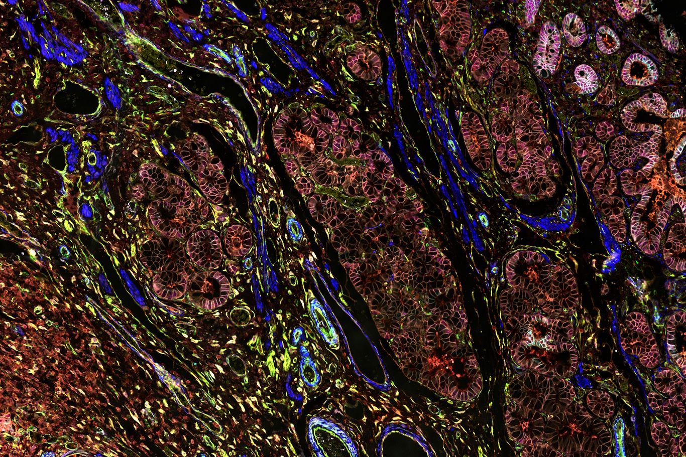 Dive into Pancreatic Cancer Research with Big Data | Learn & Share ...