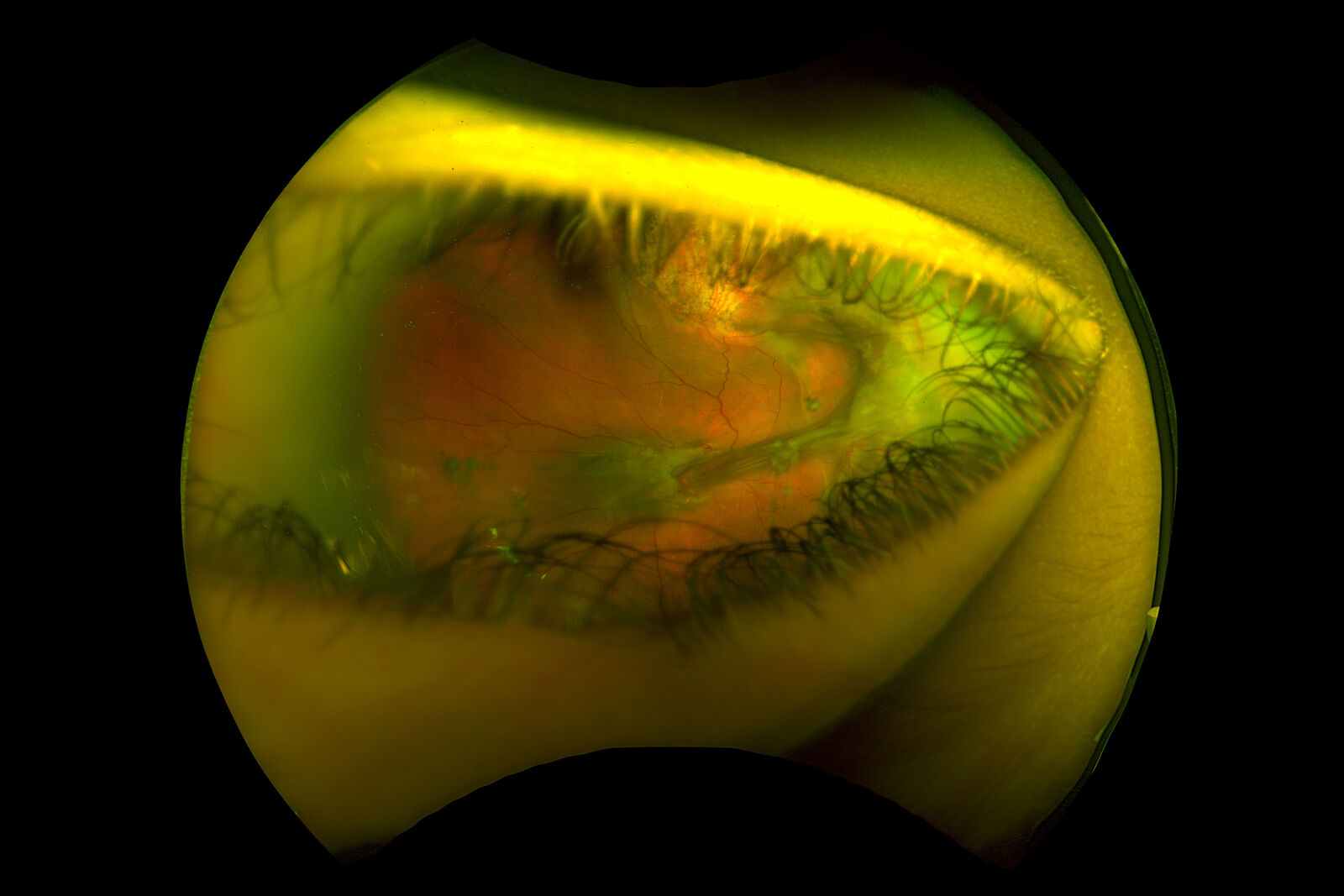 Intraoperative OCT-Assisted Surgical Management of Proliferative ...