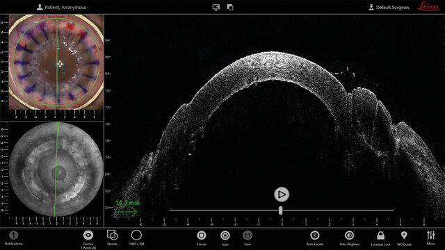 Cornea Surgery | Applications | Leica Microsystems