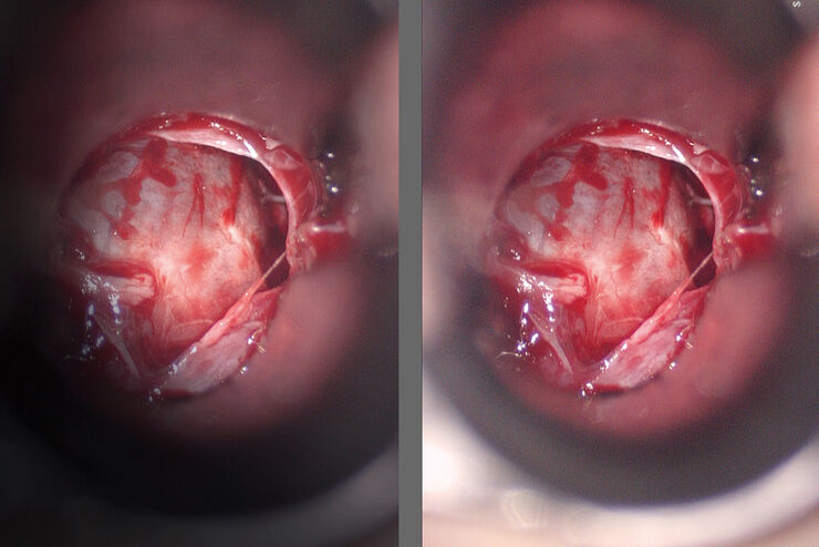 ARveo 8 Digital Visualization Microscope for Neurosurgery - Media ...