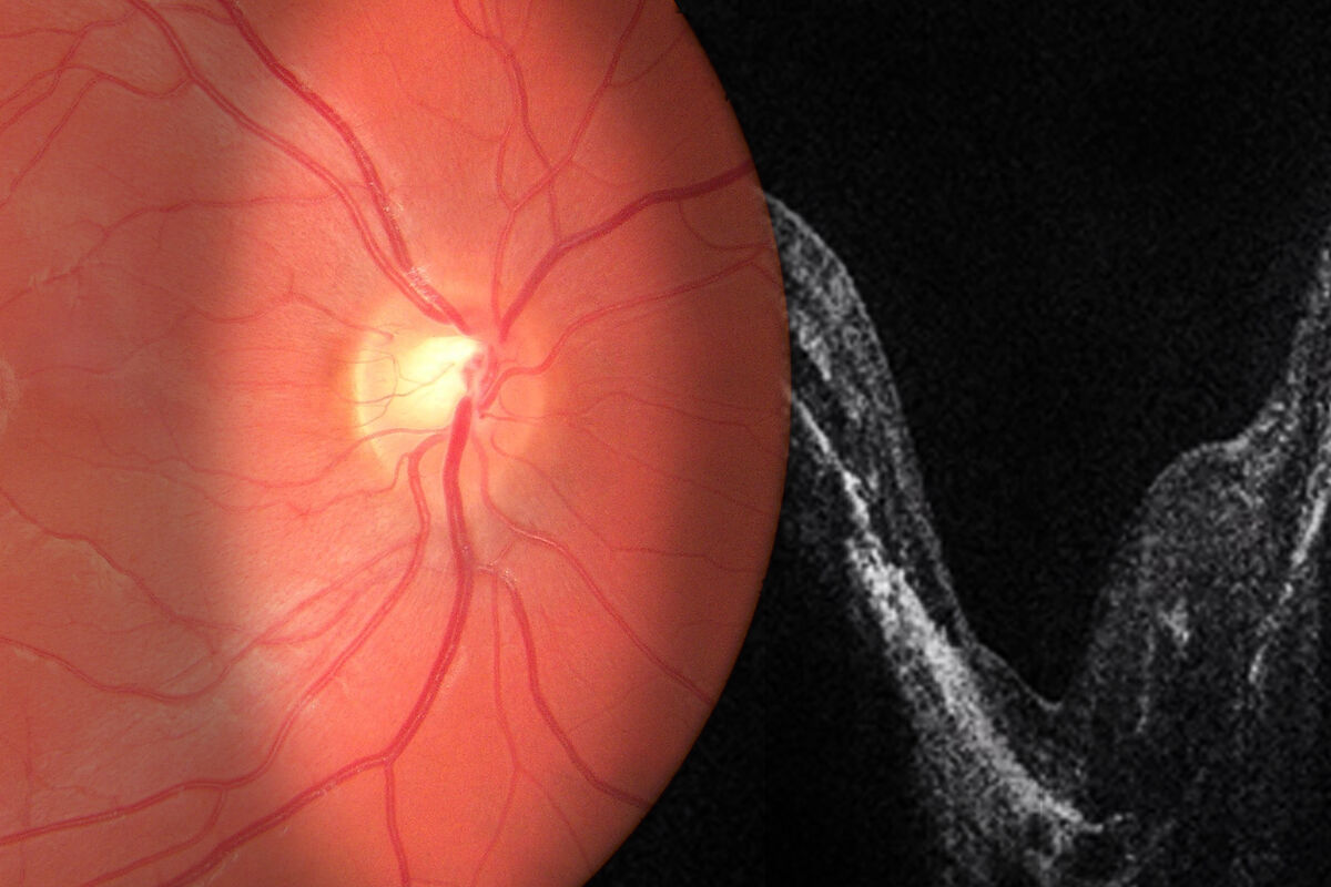 Clinical Symposium on OCT-Guided Retina Surgery | Learn & Share | Leica ...