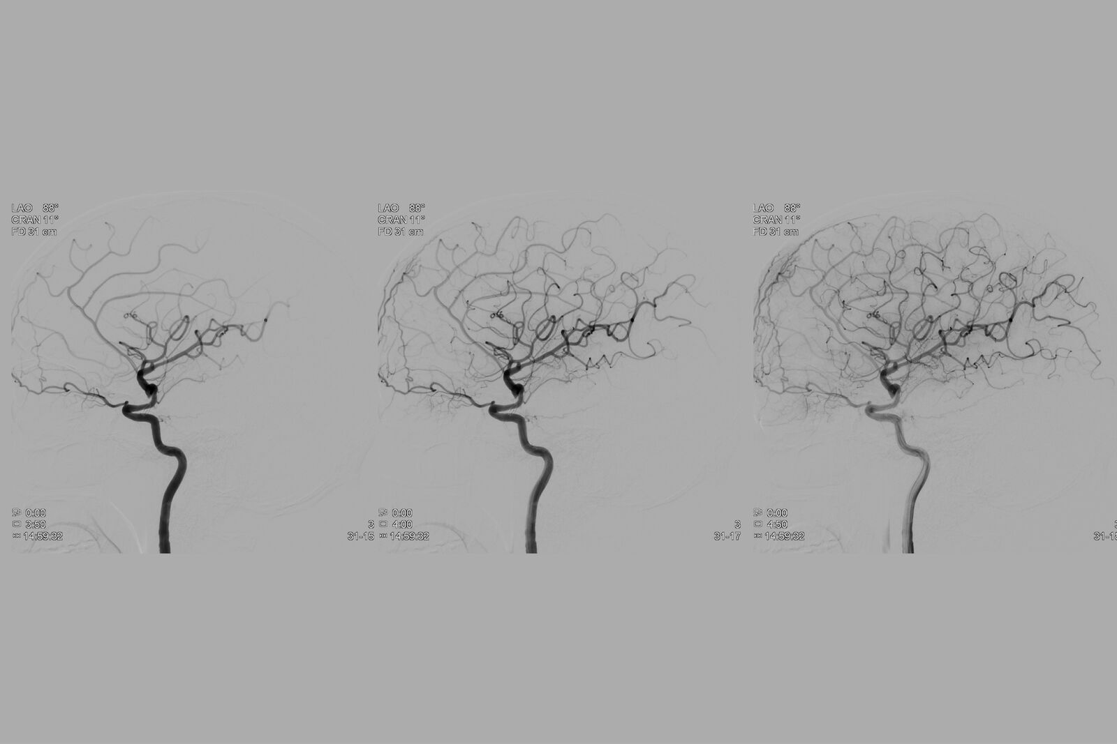 GLOW800 Augmented Reality Fluorescence in AVM (Arteriovenous ...