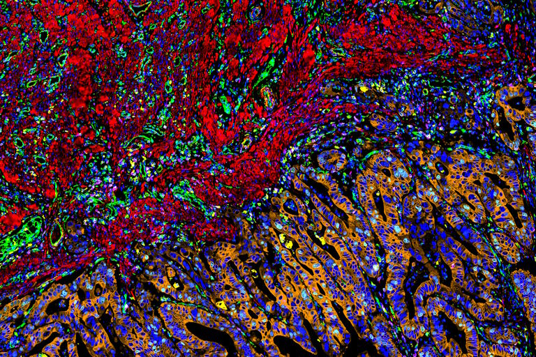 AI-Powered Multiplexed Image Analysis to Explore Colon Adenocarcinoma | Learn & Share | Leica ...