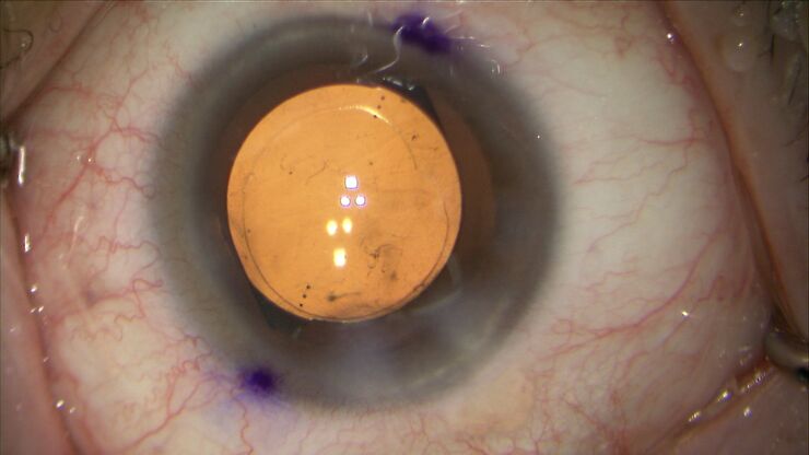 ToricEyePiece Toric IOL Placement | Products | Leica Microsystems