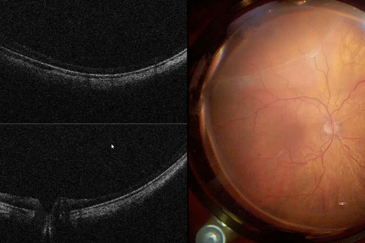 Intraoperative OCT in Retinal Procedures | Learn & Share | Leica ...