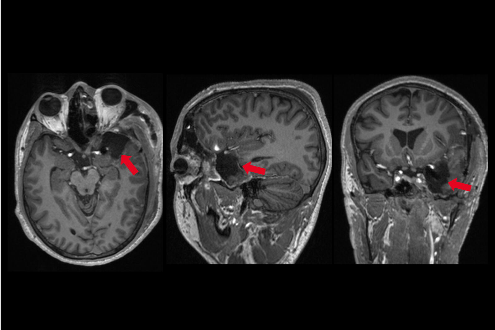 GLOW800 Augmented Reality Fluorescence in AVM (Arteriovenous ...