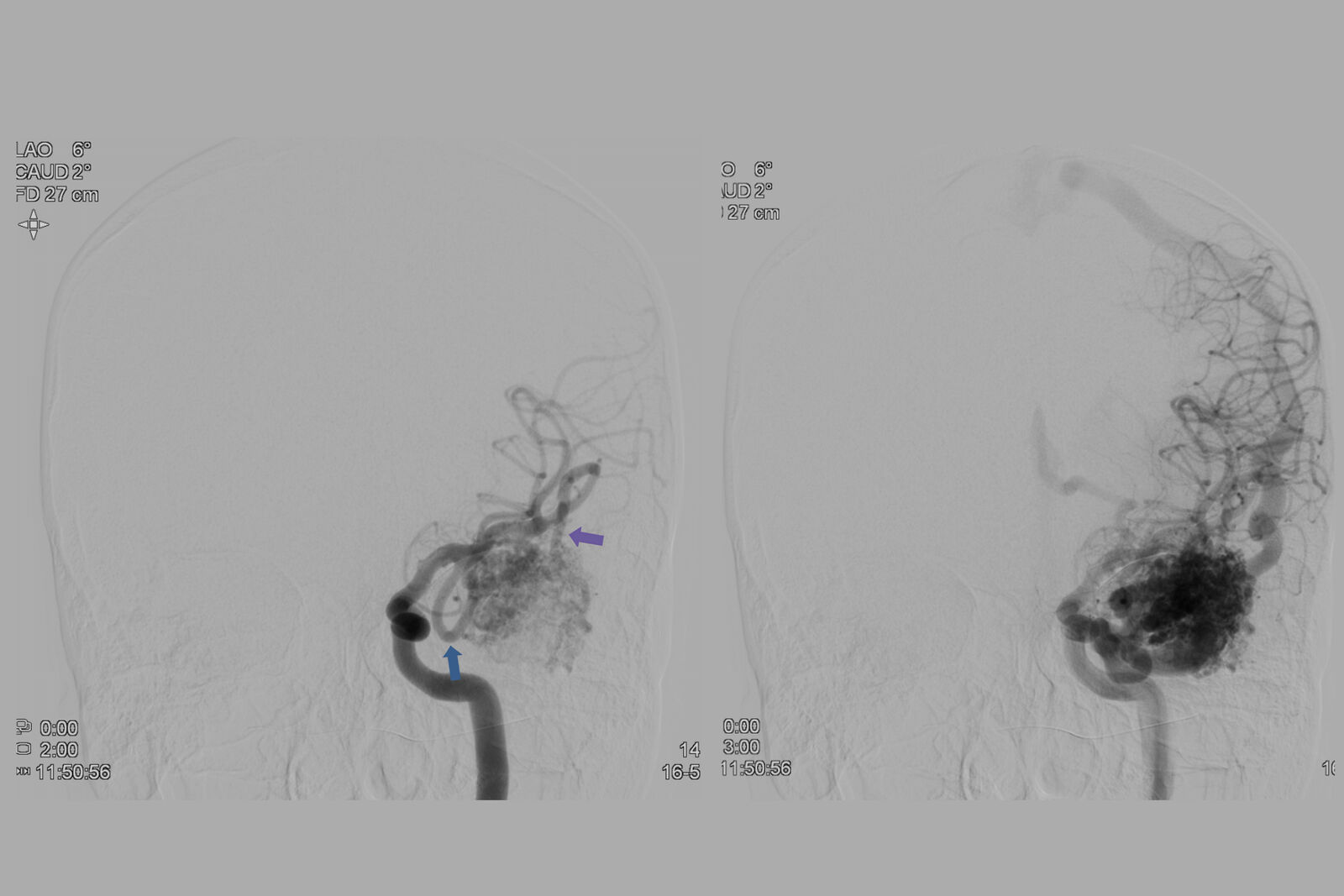 GLOW800 Augmented Reality Fluorescence in AVM (Arteriovenous ...