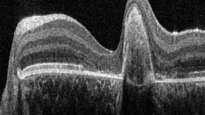 Ophthalmology | Applications | Leica Microsystems