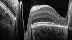 A Guide to OCT | Learn & Share | Leica Microsystems