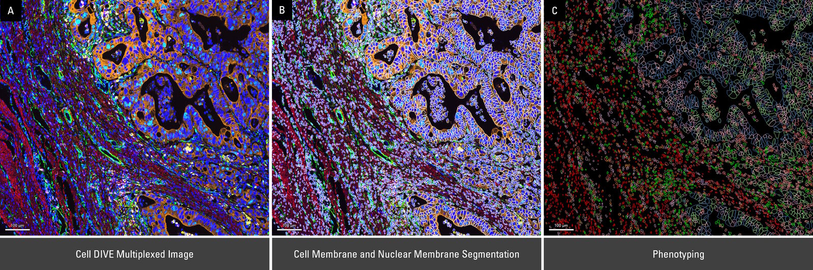 AI-Powered Multiplexed Image Analysis to Explore Colon Adenocarcinoma | Learn & Share | Leica ...
