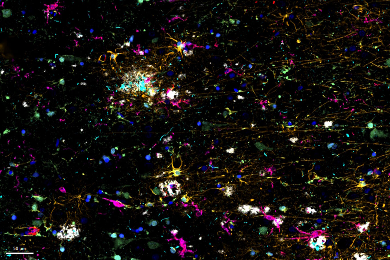 Spatial Analysis of Neuroimmune Interactions in Alzheimer’s Disease ... Spatial Analysis of Neuroimmune Interactions in Alzheimer’s Disease ...