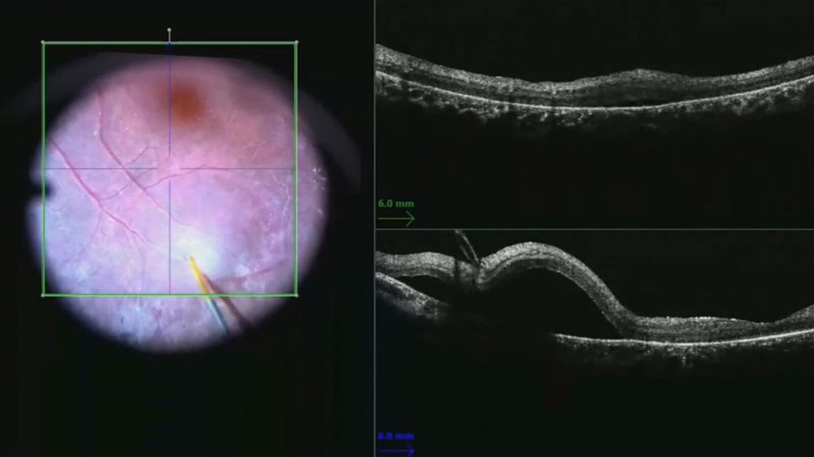 Ophthalmic Gene Therapy Subretinal Injection | Learn & Share | Leica ... Ophthalmic Gene Therapy Subretinal Injection | Learn & Share | Leica ...