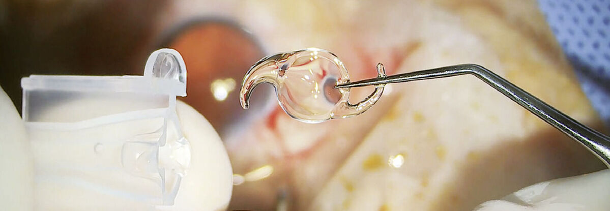 Cataract Surgery | Applications | Leica Microsystems