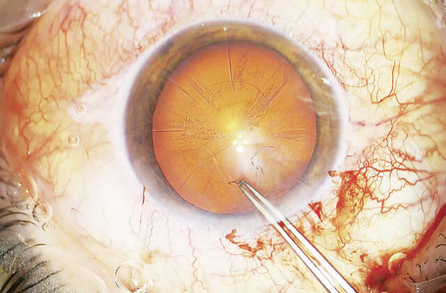 Cataract Surgery | Applications | Leica Microsystems