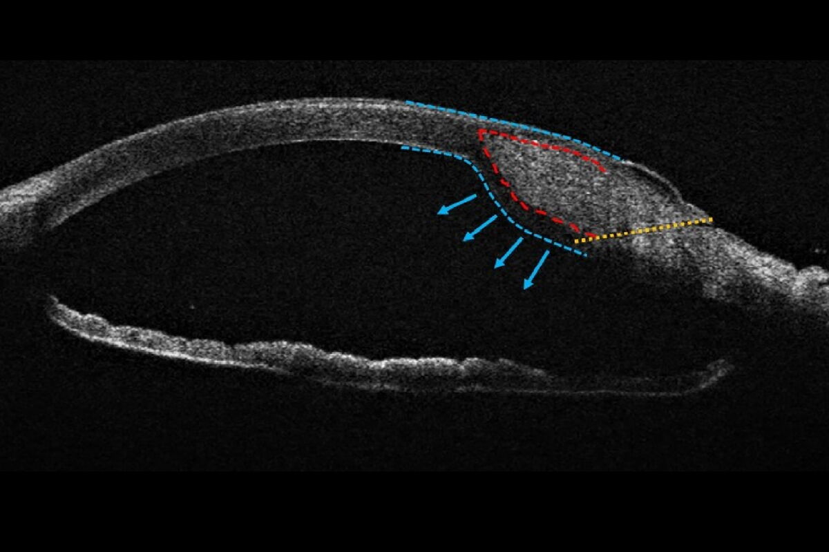 Towards Advanced Use of Intraoperative OCT in Cataract Surgery | Learn ...