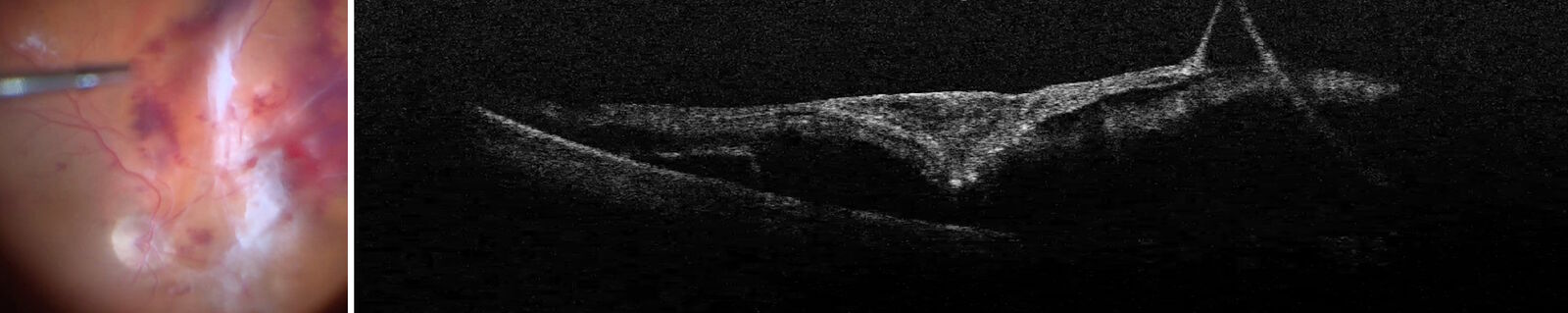 Posterior Segment Surgery: Benefits of Utilizing Intraoperative OCT ...