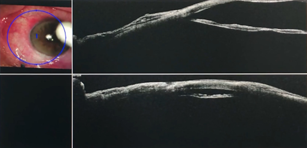 How Intraoperative OCT Helps Gain Greater Insight in Glaucoma Surgery ...