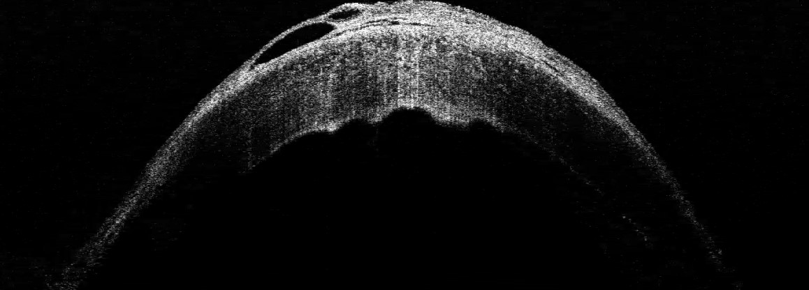 Intraoperative OCT-Assisted Corneal Transplant Procedures | Learn ...