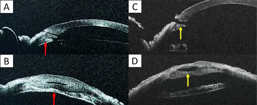 Towards Advanced Use of Intraoperative OCT in Cataract Surgery | Learn ...