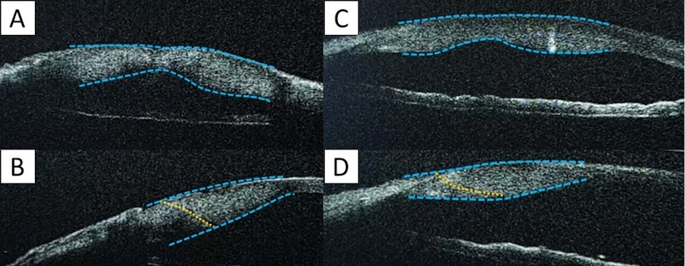 Towards Advanced Use of Intraoperative OCT in Cataract Surgery | Learn ...