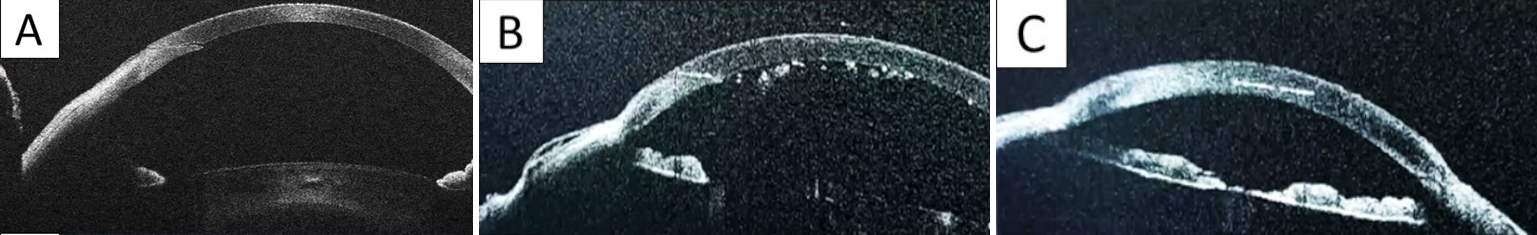 Towards Advanced Use of Intraoperative OCT in Cataract Surgery | Learn ...