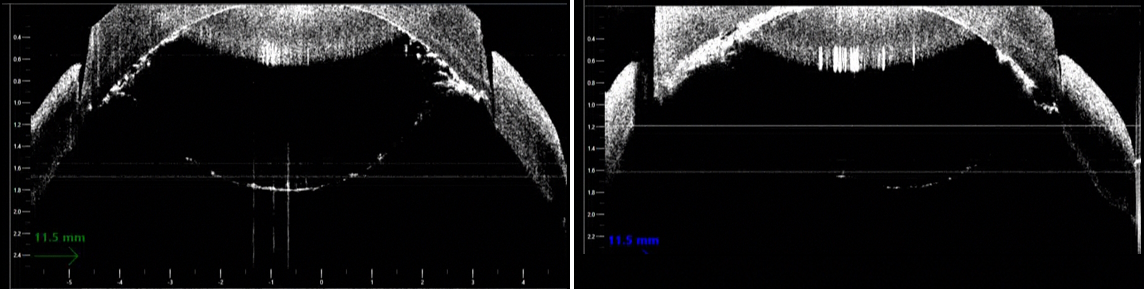 How does Real-time OCT Imaging Impact Precision in Corneal Surgery ...