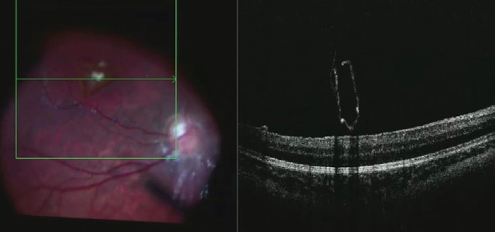 Improve Macular Hole Surgery with Optical Coherence Tomography | Learn ...
